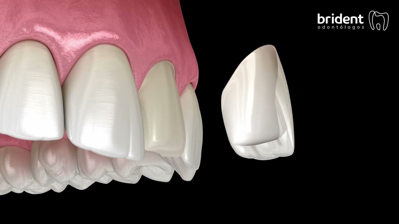 Carillas dentales 1  Modelado 3D
