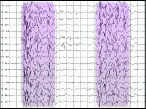 EEG Reading Rounds (Burst Suppression)