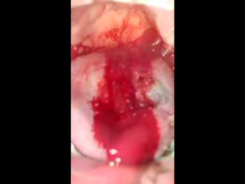 Post tonsillectomy bleed