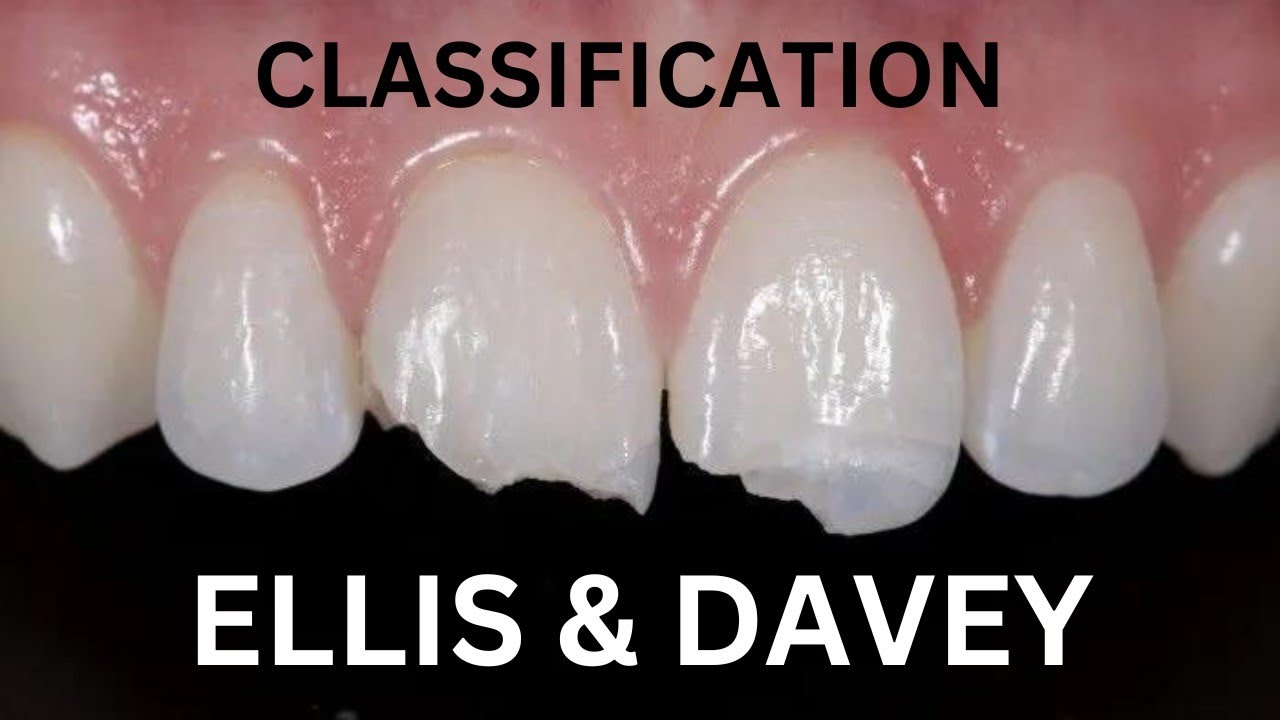 Ellis & Daveys Classification of Traumatic Injury | Class I to IX