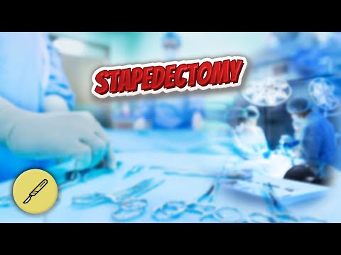 Stapedectomy - Everything Surgeries ✅😬⁉️