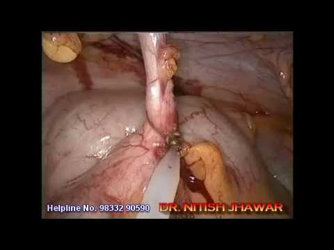 Laparoscopic Appendectomy - Appendix Surgery