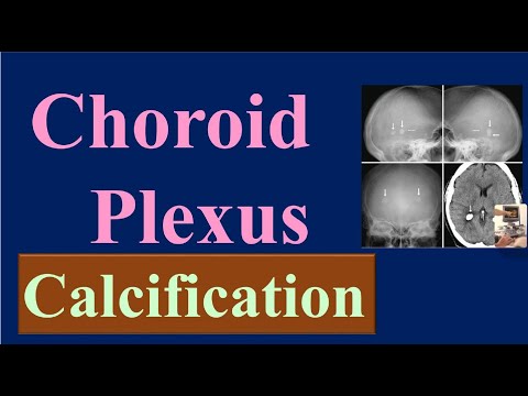 What's Hiding Behind Your Choroid Plexus Calcification Diagnosis?