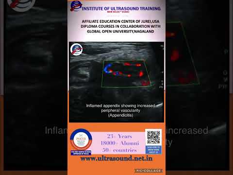 #appendicitis #ultrasoundtraining #pocus