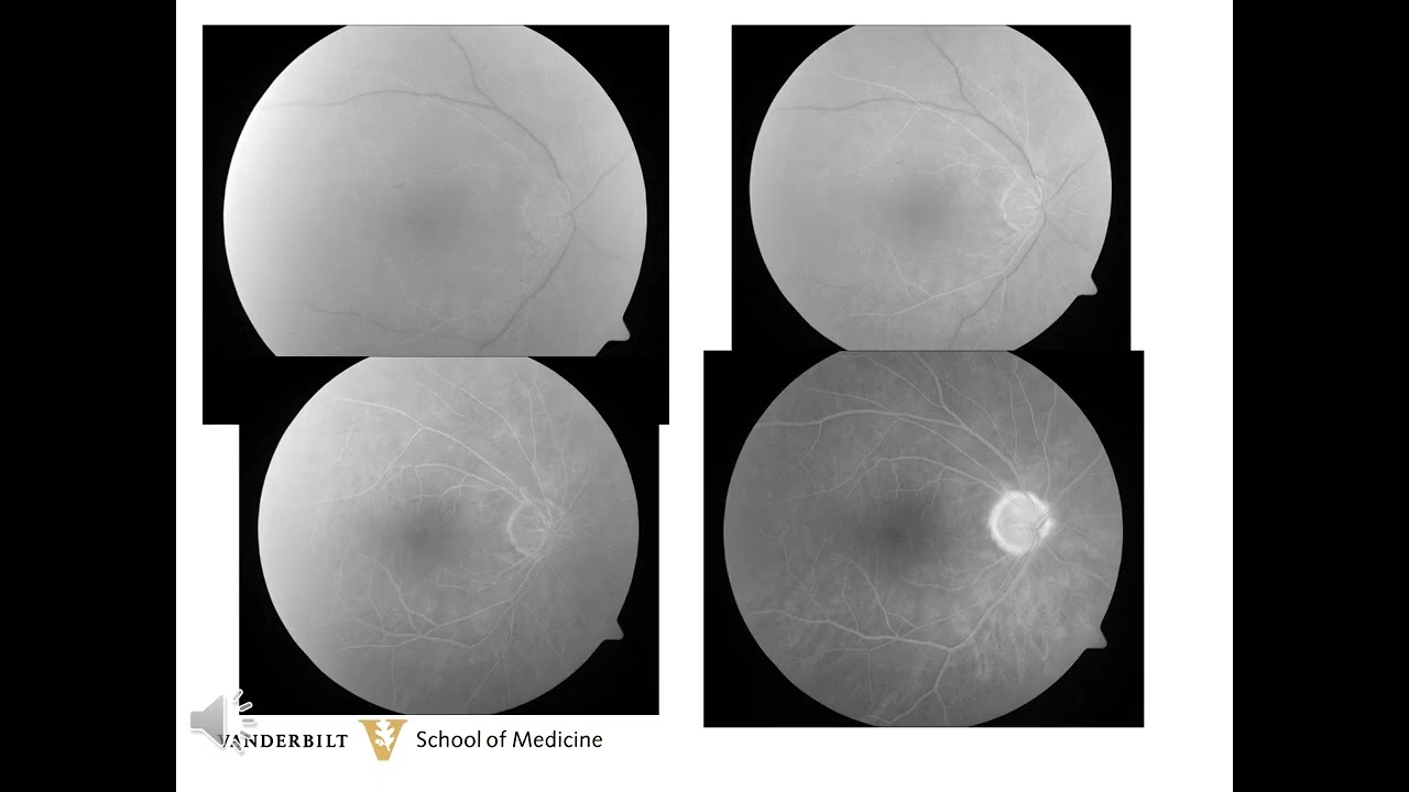4 CRAO ancillary tests