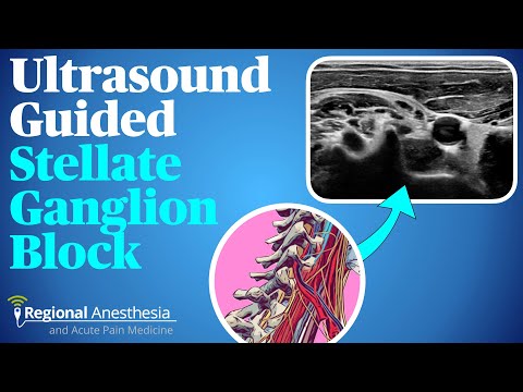 Ultrasound guided stellate ganglion block