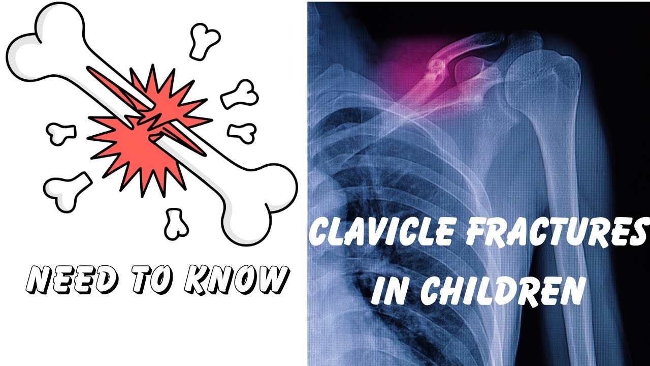 Clavicle Fractures in Children  What Parents Need to Know