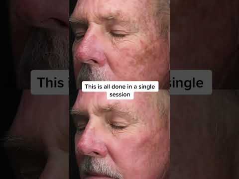 The BEST Way to Get Smooth Skin With Much Less Wrinkles! 🙌 #antiaging #laserresurfacing #co2laser