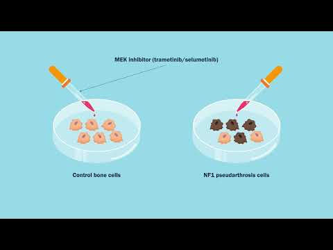 Molecular Evidence Supporting MEK Inhibitor Therapy in NF1 Pseudarthrosis