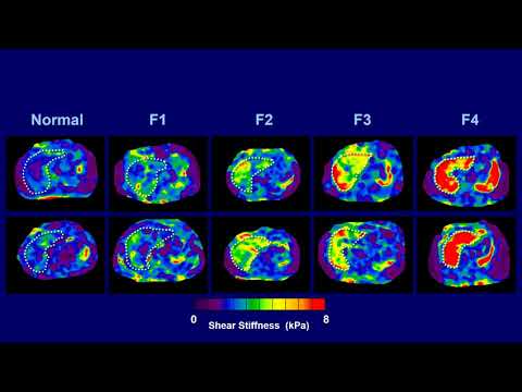 MRE Update for #RSNA22