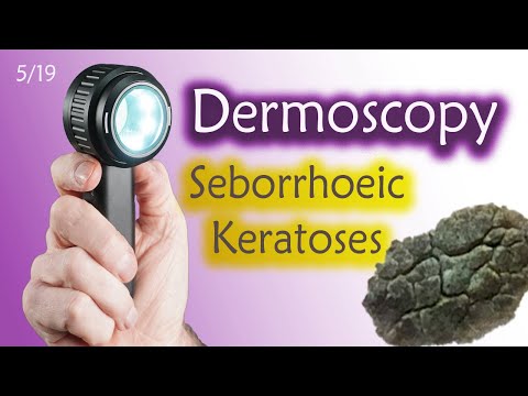 Are Seborrhoeic Keratoses [Seb K] the Chameleon of Primary Care Dermoscopy?