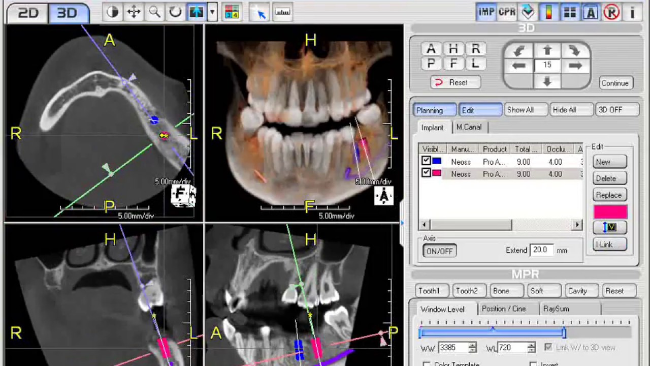 PreXion Implant Planning