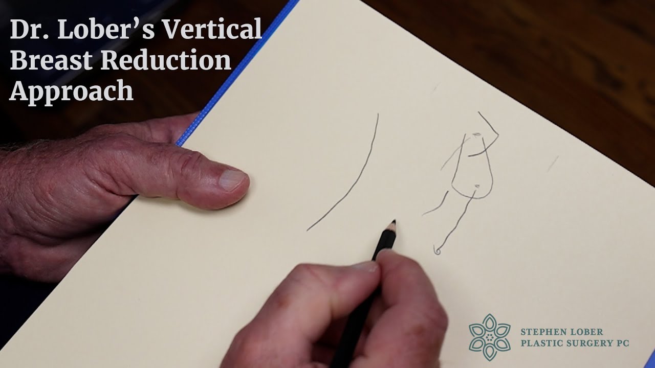 Detailing the Vertical Breast Reduction Surgery Approach