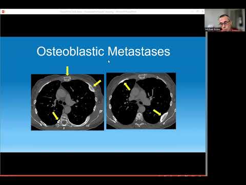 Incidental findings on AC imaging: a radiologist’s perpective