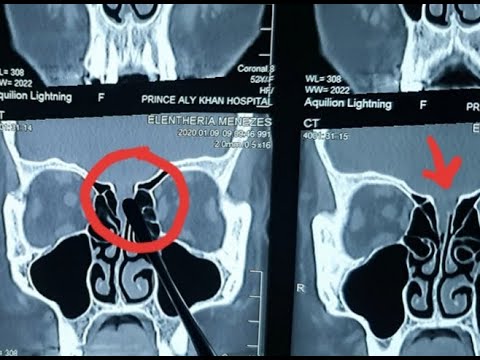 MENINGOCELE- Cribriform CSF leak explained on CT PNS . CT PNS made simple A to Z. Dr.Ajinkya Kedari