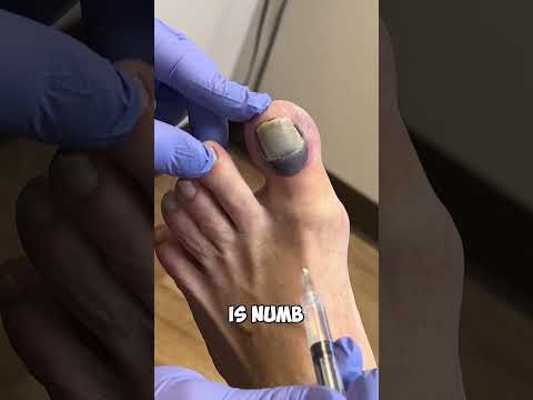 Ouch! Numbing A Toe: A Quick Fix"