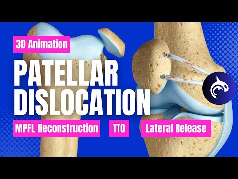How It's Fixed - Patellar Dislocation: MPFL Repair, Tibial Tubercle Osteotomy, and Lateral Release