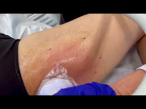 Cryo T-shock Treatment in action