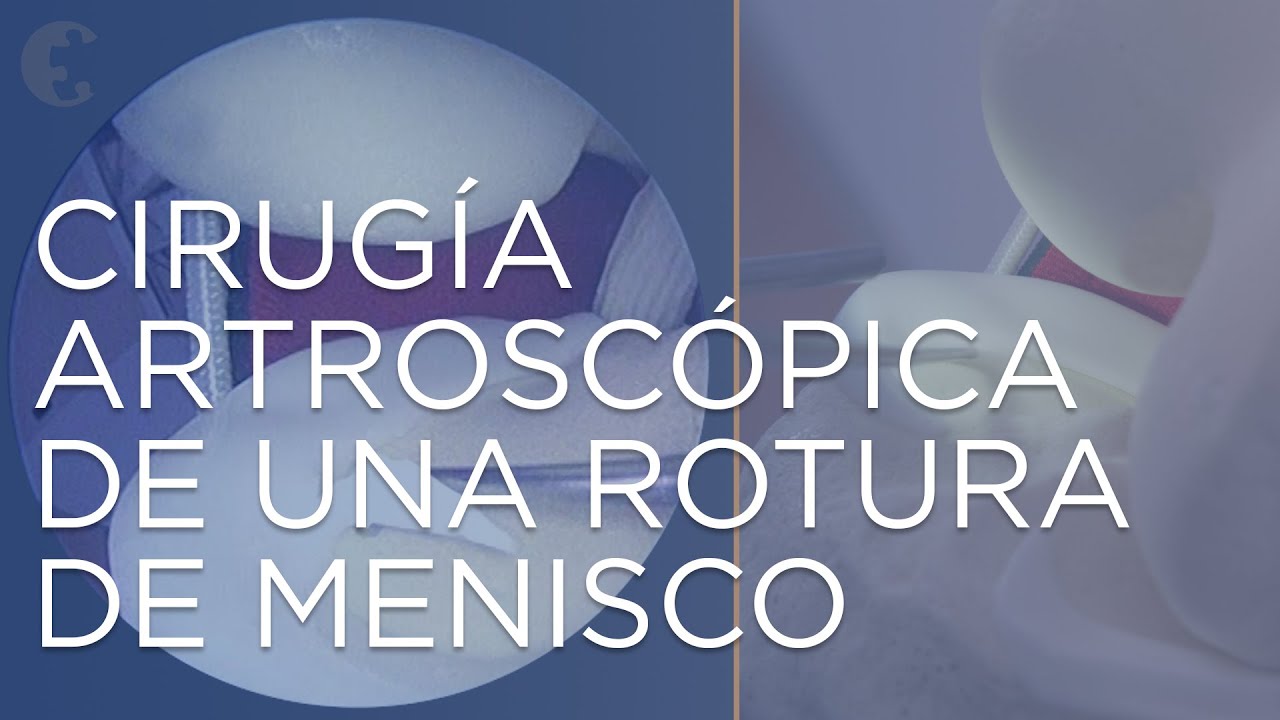 ¿Cómo se opera un menisco?  | Meniscectomía: Cirugía artroscópica