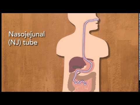 Why are there different types of feeding tubes?