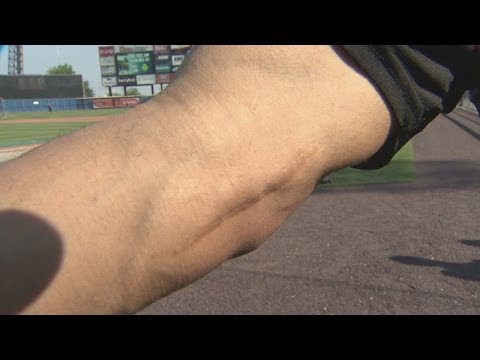 Why Are So Many Pitchers Requiring Tommy John Surgery?