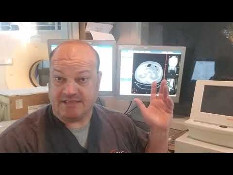 Abdominal pelvis Cat Scan