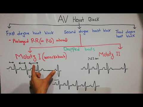CVS physiology 49.Second degree heart block,Mobitz type 1(Wenckebach)& Mobitz type 2. Dropped beats