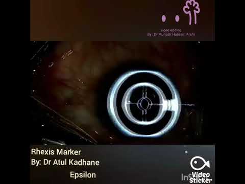 Rhexis Marker by Dr Atul Kadhane