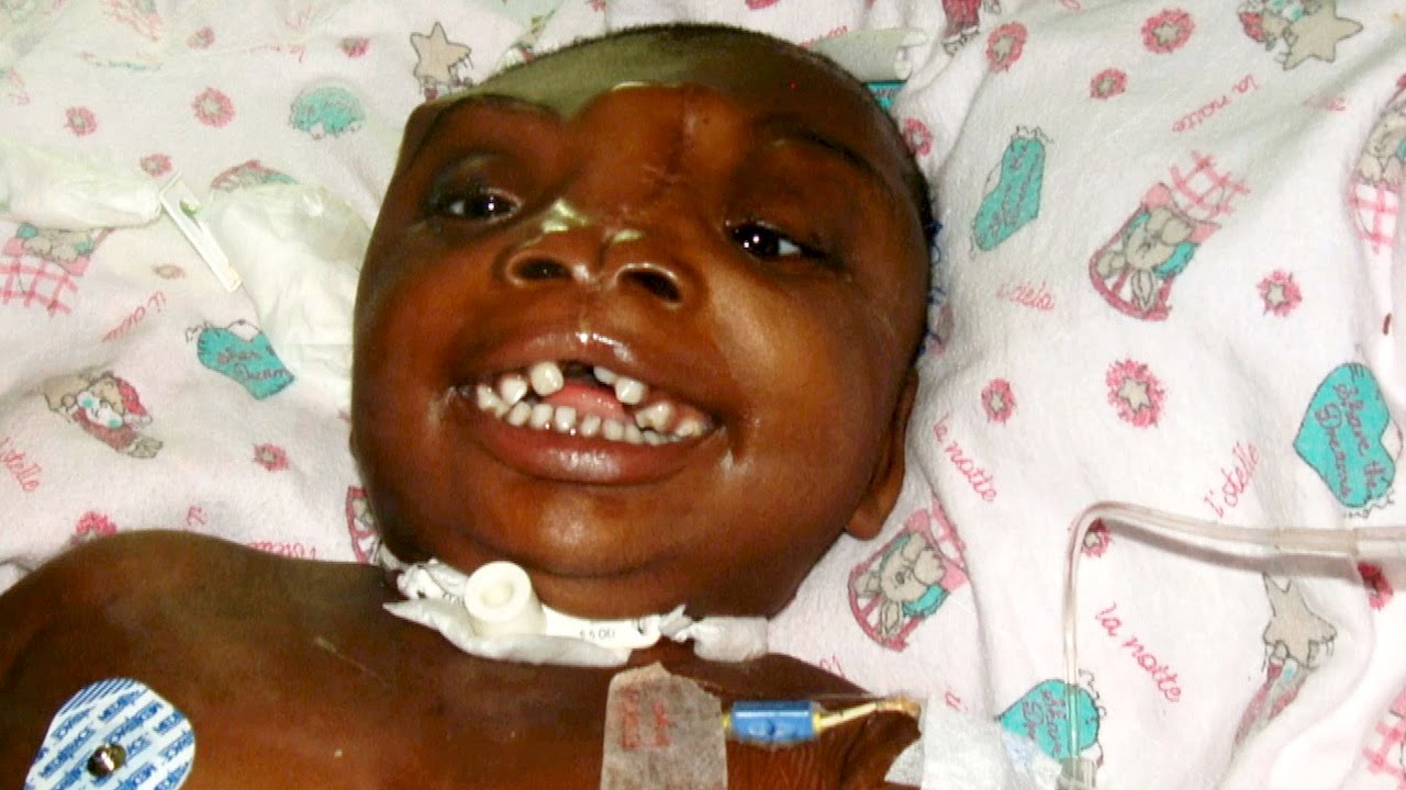 Girl born without a forehead undergoes pioneering 3D surgery to fill ...