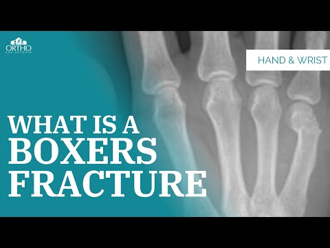 What Is A Boxers Fracture? #injury