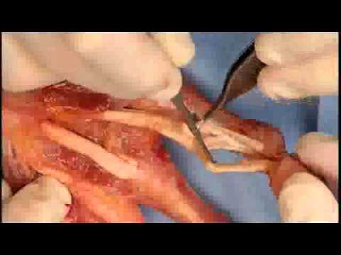 Under the Skin: Relating Tendon Anatomy of the Hand to Clinical Questions Preview