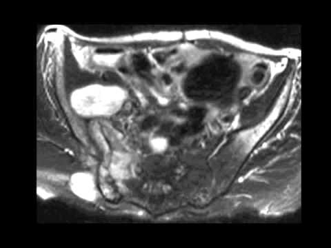 Unilateral Sacroilitis from Tuberculosis