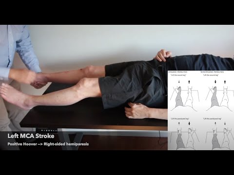 Functional Neurological Disorders & Stroke Mimics: Hoover Sign