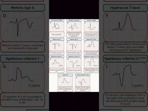 some positive changes in ecg // ST elevation// ST depression// positive ecg pattern #cardio #heart