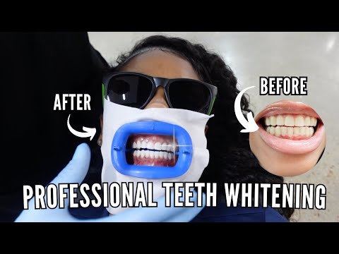 I Got My Teeth Professionally Whitened! 🦷✨ | Real Results + Honest Experience