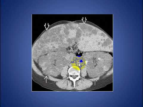 Bilateral Renal Cysts