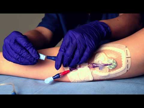 How to Use DualCap® IV Pole Strips™