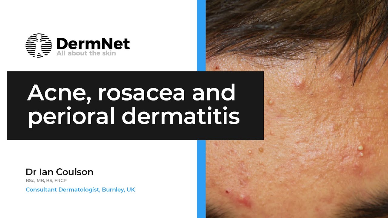Acne, Rosacea, and Perioral Dermatitis
