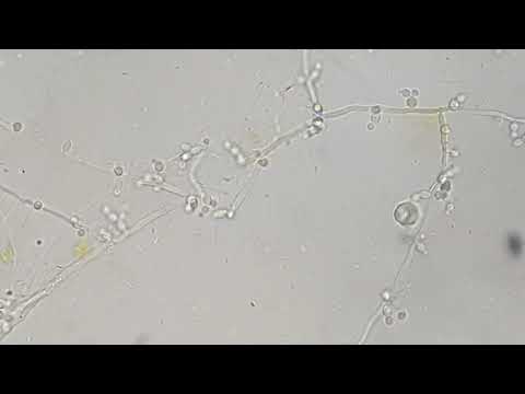Yeast cells, budding yeasts and Pseudohyphae in Bile KOH mount