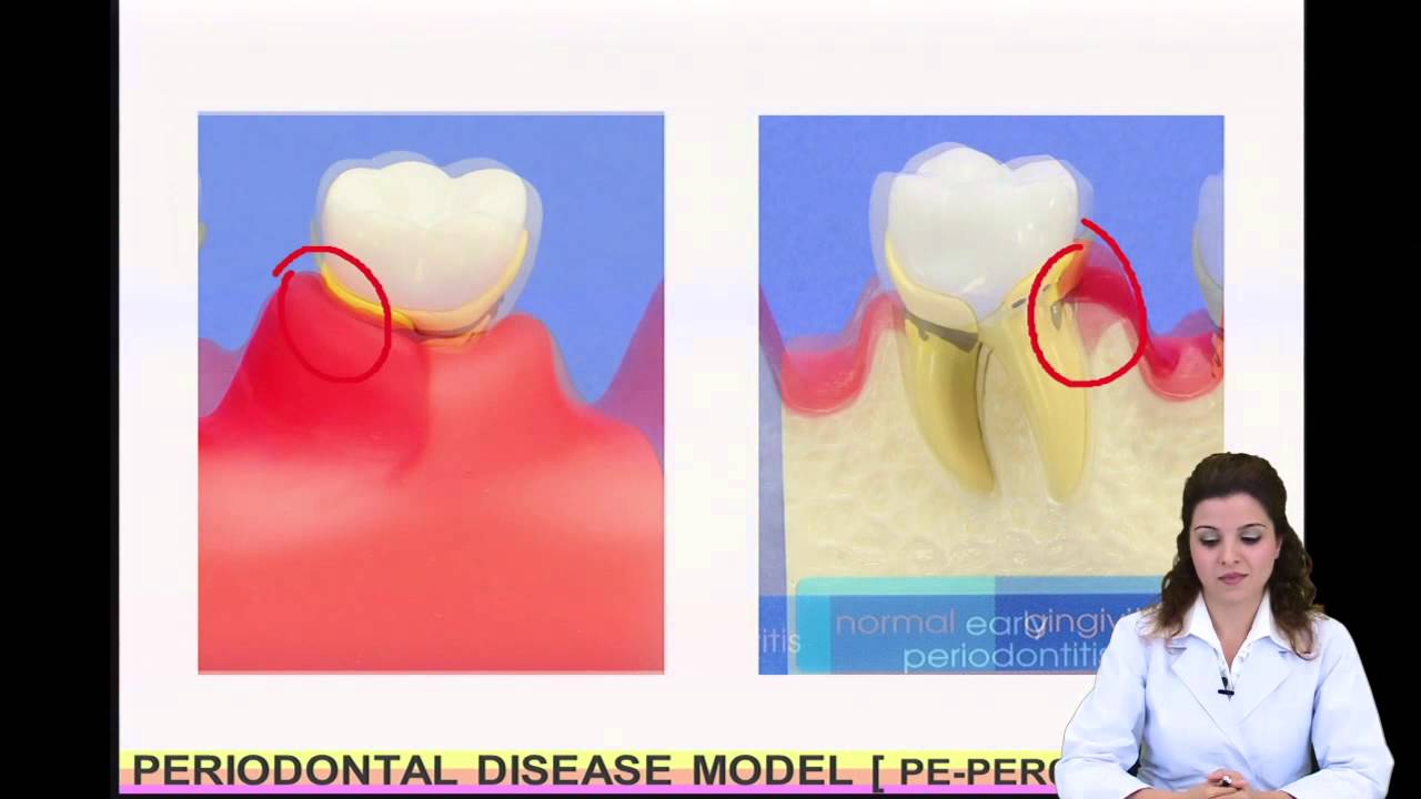 NISSIN: PERIODONTAL DISEASE MODEL [PE-PER010]