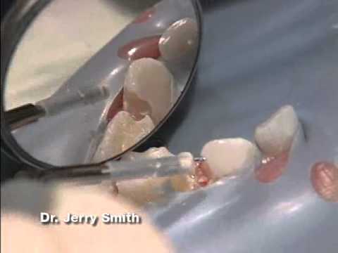 Root Repair: Pulp Cap case