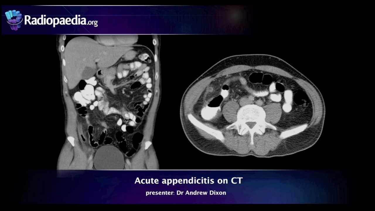 Acute appendicitis on CT - radiology video tutorial