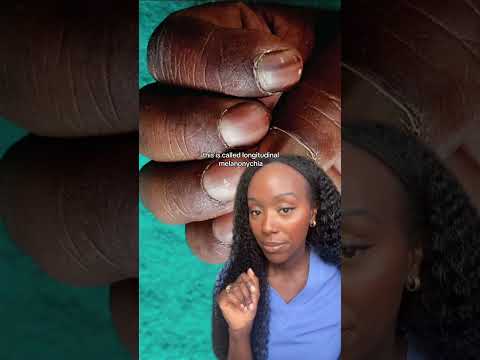Kai Cenat Has A Rare Nail Condition (Longitudinal melanonychia)