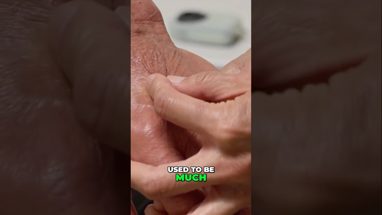 Stanford Rheumatologist SCLERODERMA Hand Exam