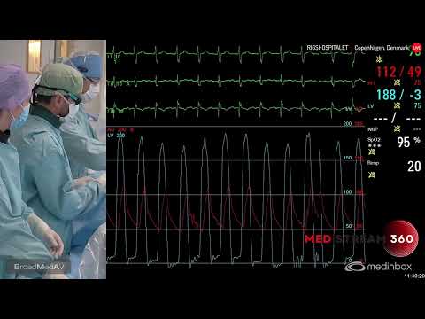 TAVI Using A Navitor SEV