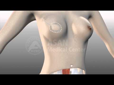 TRAM Flap Breast Reconstruction