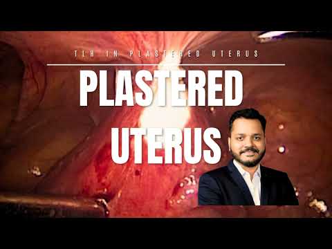 #216 : TOTAL LAPAROSCOPIC HYSTERECTOMY IN A CASE OF PREV 4 LSCS WITH PLASTERED UTERUS