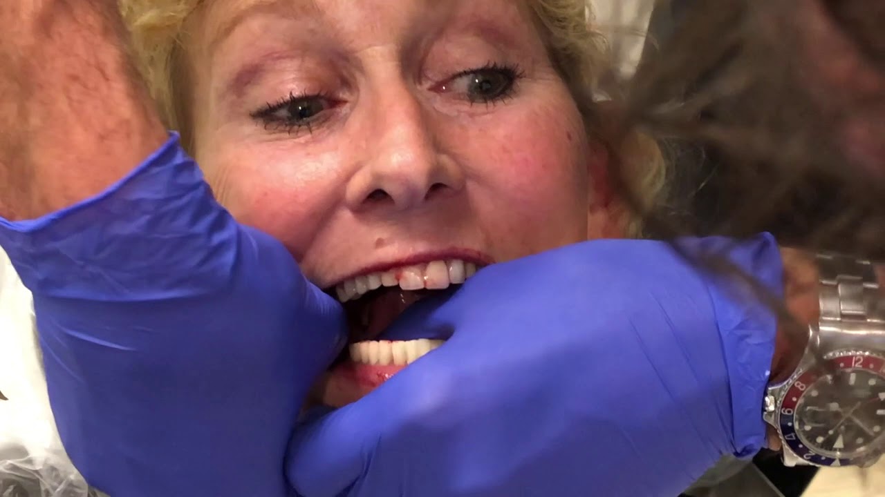 Immediate Denture EASY DENTURE™