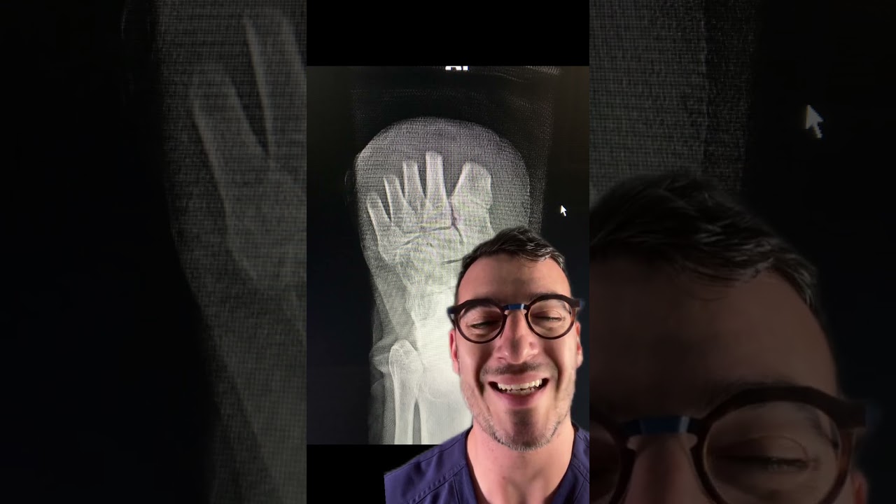 Transmetatarsal Amputation