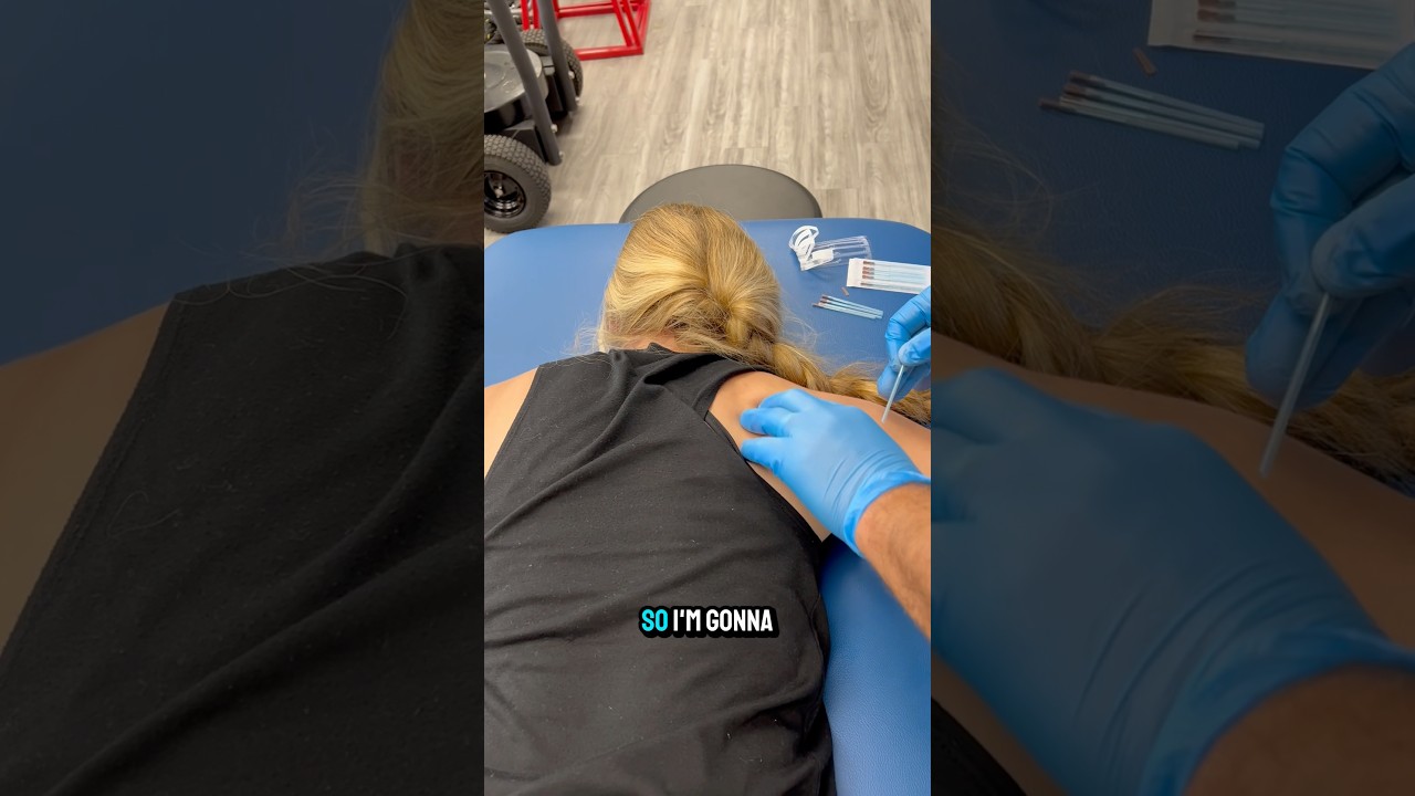 Dry needling is used to treat a variety of issues like neck, shoulder, & back pain  #dryneedling